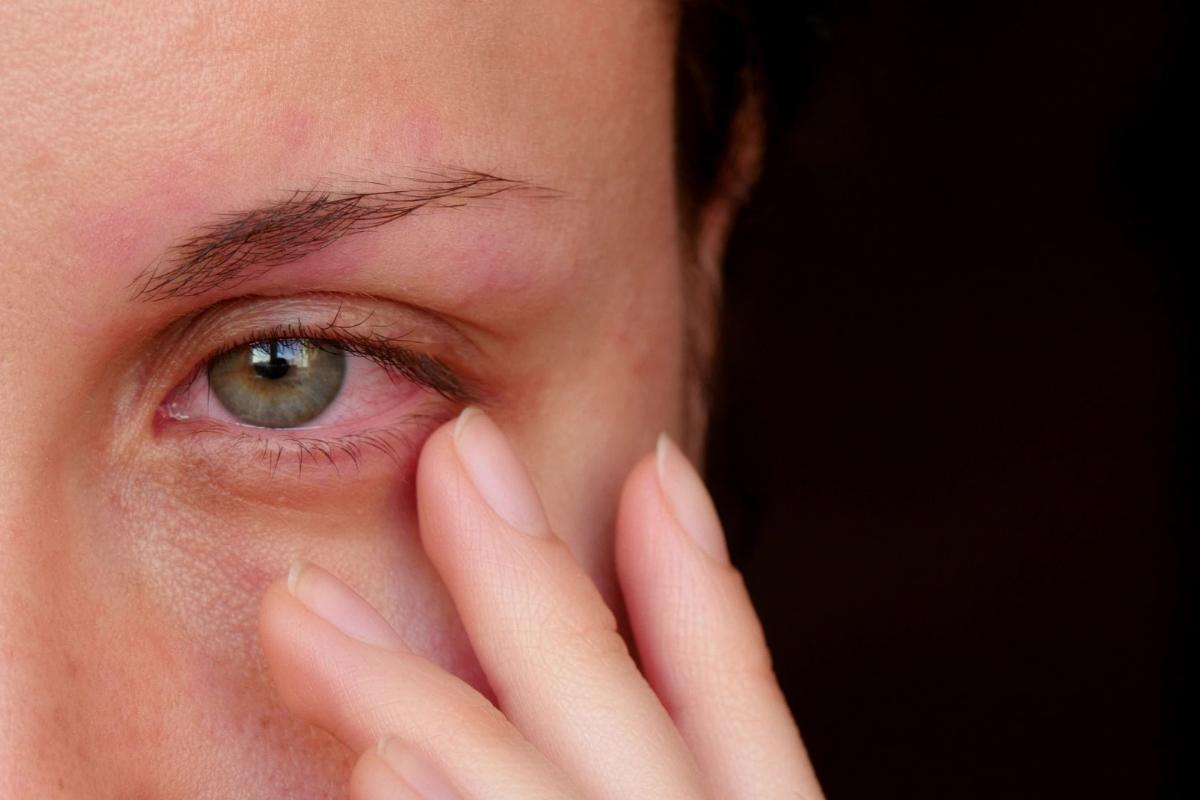 What Are Alcoholic Eyes? | Addiction Treatment | Wrightsville, PA